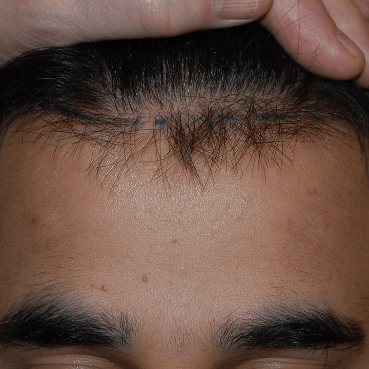 Norwood Scale: Causes, Stages & Treatments | Wimpole Clinic