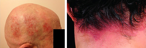 8 Common Scalp Problems: Photos, Causes, Treatments