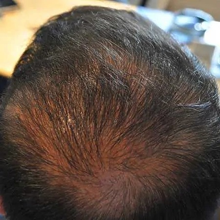 FUE Hair Transplants: Everything You Need To Know