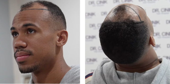Gabriel Magalhães Hair Transplant: Everything You Need To Know