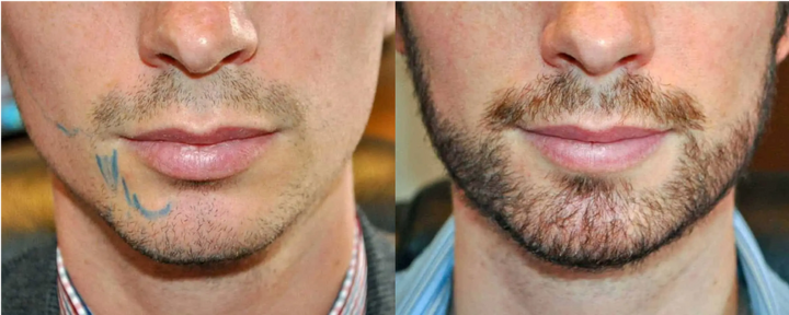 Beard Transplant London - Facial Hair Loss - Wimpole Clinic