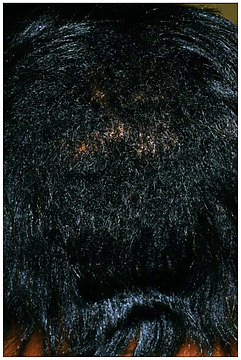 What To Do About Frizzy Broken Hair On Top Of Your Head