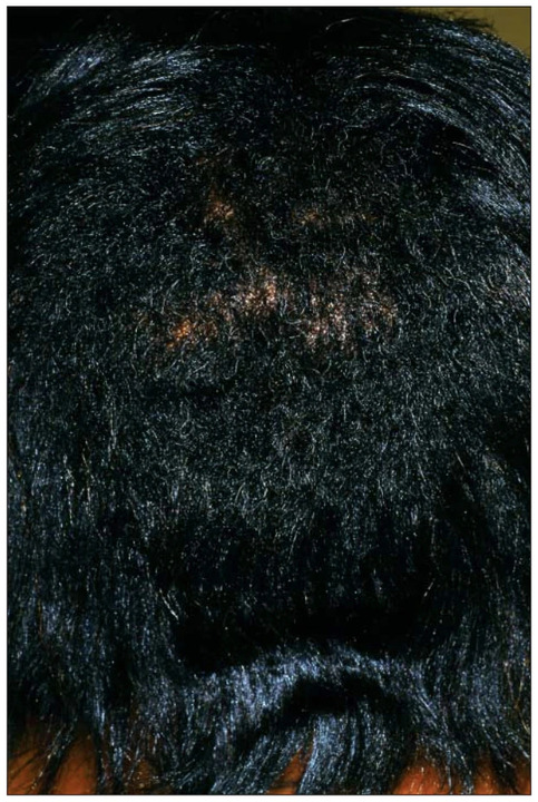 What To Do About Frizzy Broken Hair On Top Of Your Head