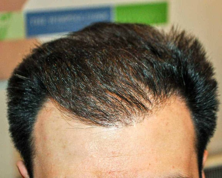 How Many Hair Grafts Do I Need? | Wimpole Clinic