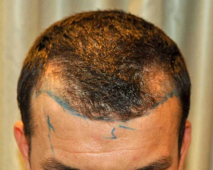 Norwood Scale: Causes, Stages & Treatments | Wimpole Clinic