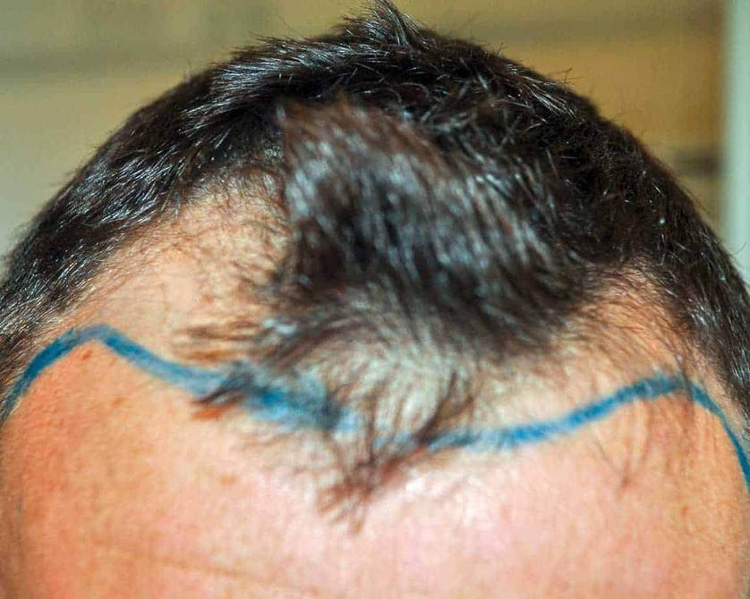 1500 Graft Hair Transplant: Coverage, Results, Costs