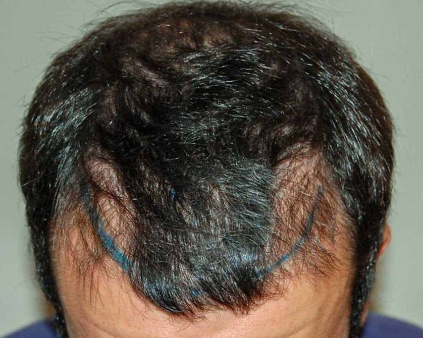 Norwood Scale: Causes, Stages & Treatments | Wimpole Clinic