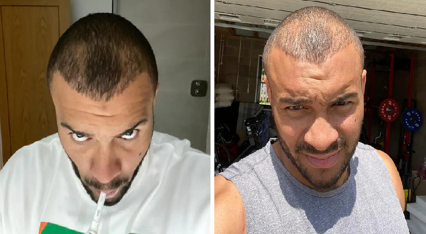 Jonathan Joseph Hair Transplant: Everything You Need To Know