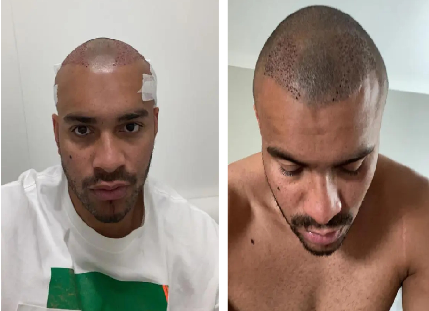 Jonathan Joseph Hair Transplant: Everything You Need To Know