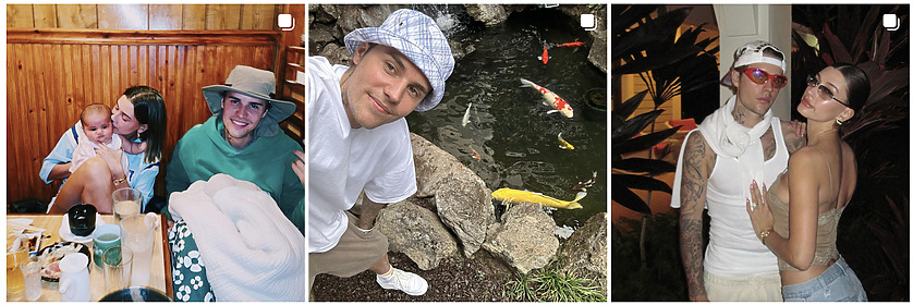 Justin Bieber Hair Loss: Everything You Need To Know