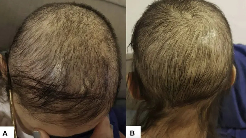 Minoxidil Results After 1 Year - Wimpole Clinic