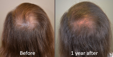 Minoxidil Results After 1 Year - Wimpole Clinic