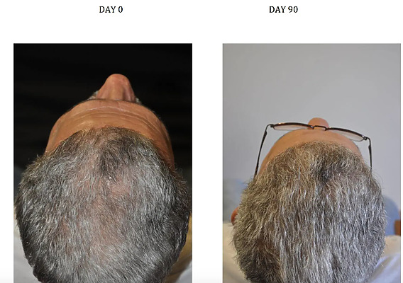 Nanoxidil Guide: Uses, Results & Side Effects - Wimpole Clinic