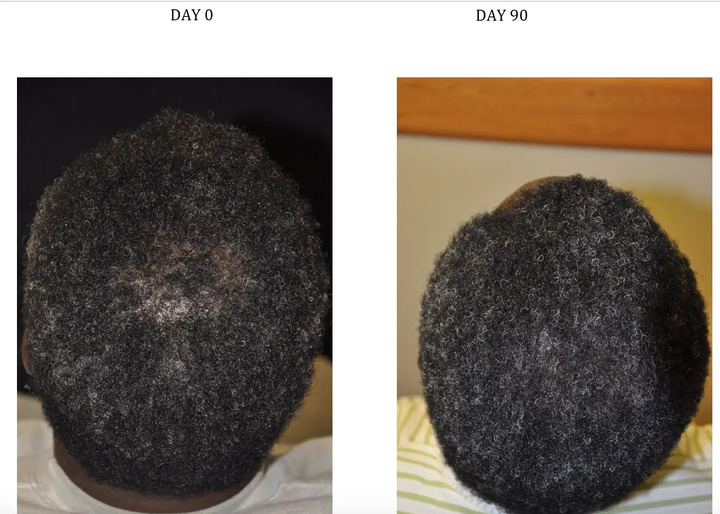 Nanoxidil Guide: Uses, Results & Side Effects - Wimpole Clinic