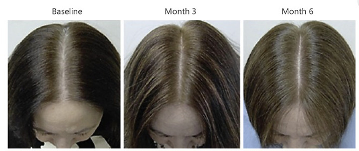 Nanoxidil Guide: Uses, Results & Side Effects - Wimpole Clinic