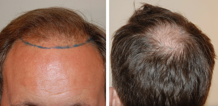 Norwood Scale: Causes, Stages & Treatments | Wimpole Clinic