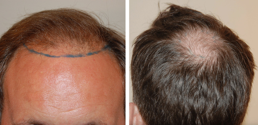 Norwood Scale: Causes, Stages & Treatments | Wimpole Clinic