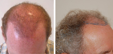 Norwood Scale: Causes, Stages & Treatments | Wimpole Clinic