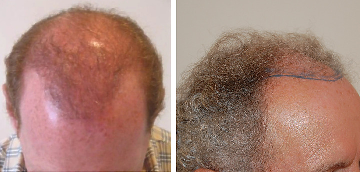 Norwood Scale: Causes, Stages & Treatments | Wimpole Clinic