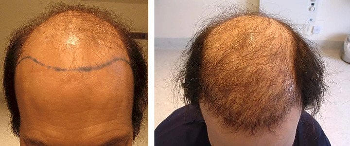 Can You Get A Hair Transplant If You Are Completely Bald?
