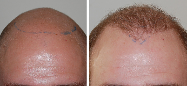 Hair Transplant After 6 Months: Photos, Results, Side Effects