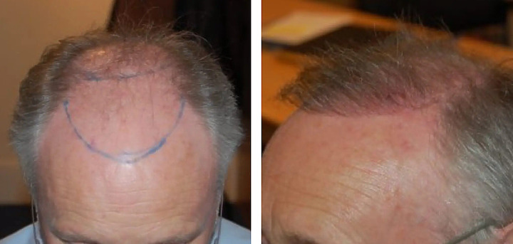 Hair Transplant After 3 Months: Photos, Results, Side Effects
