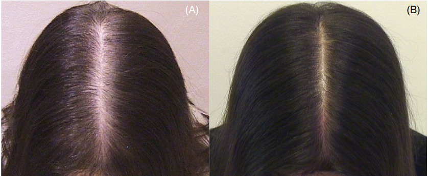 Normal Hair Parting Width vs Thinning: Causes and Treatments
