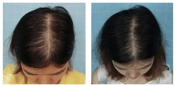 Normal Hair Parting Width vs Thinning: Causes and Treatments