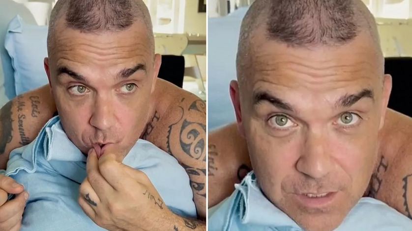 Robbie Williams Hair Transplant: Everything You Need To Know