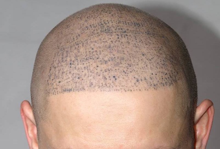 8 Scalp Micropigmentation Regrets And How To Avoid Them