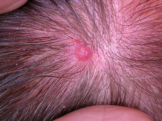 Recurring Scab On Scalp In The Same Spot: How to Treat