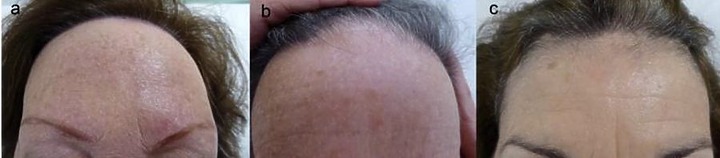Frontal Balding: Causes, Symptoms, Treatments | Wimpole Clinic