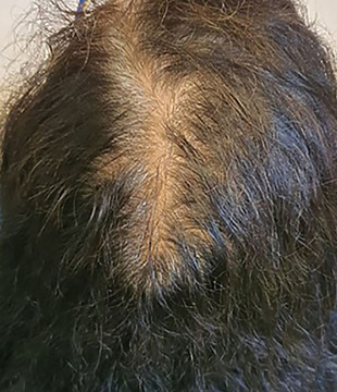 Types Of Alopecia: Causes, Symptoms, Treatments - Wimpole Clinic