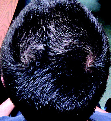 Double Crown Vs Balding: Differences, Symptoms, Treatments