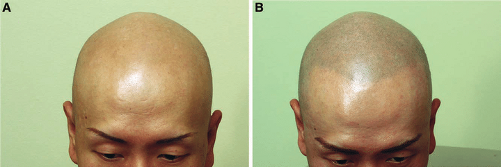 Norwood Stage 7: Photos, Treatments, Results