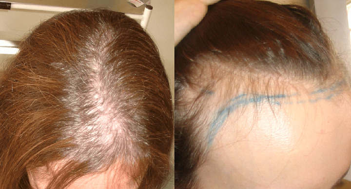 Androgenetic Alopecia: Causes, Diagnosis & Treatment