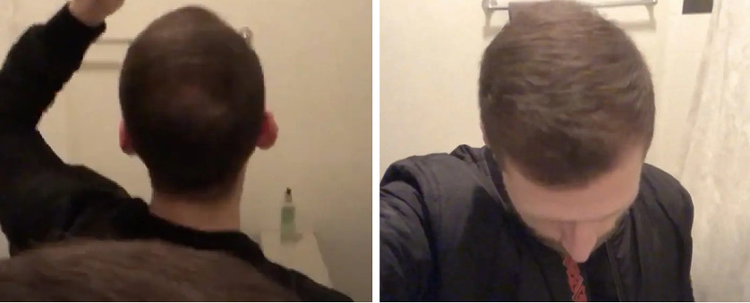 Finasteride Results: Timeline, Photos, Before & After