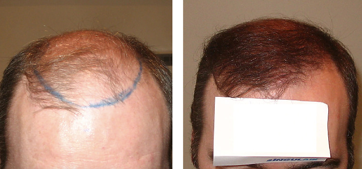 Norwood Stage 5: Photos, Treatments, Results | Wimpole Clinic