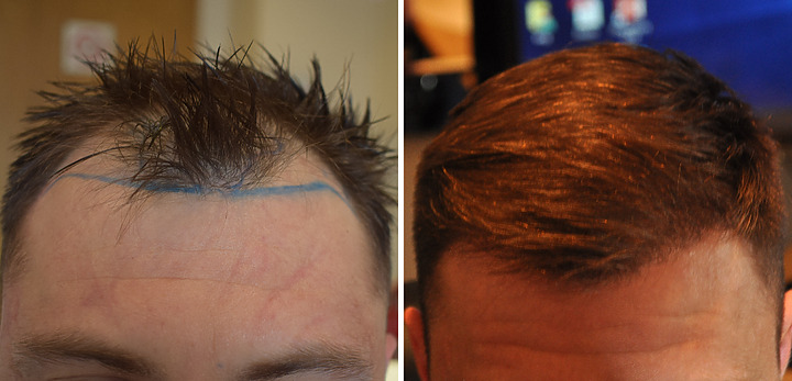 Norwood Stage 5: Photos, Treatments, Results | Wimpole Clinic