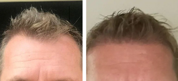 1500-Grafts Hair Transplant: Coverage, Results, Risks & Costs