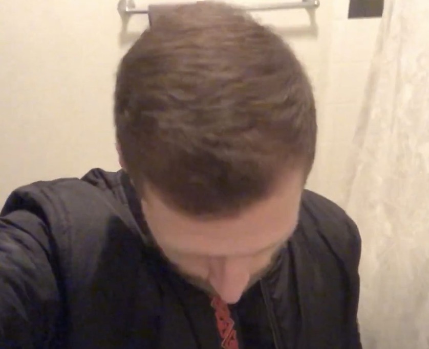 Finasteride Results: Timeline, Photos, Before & After