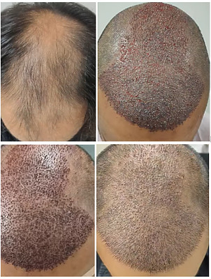 Hair Transplant After 10 Days: Photos, Results & Aftercare