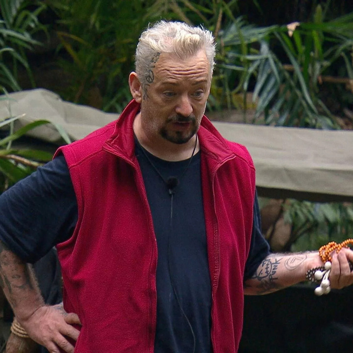 Boy George Hair Transplant: Everything You Need To Know