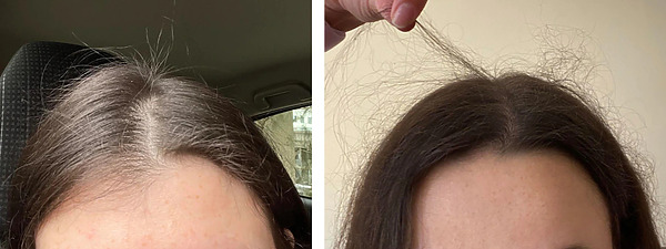 Hair Breakage: Causes, Symptoms, Treatments & Photos