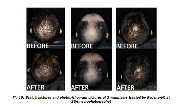 Redensyl Guide: Uses, Results, Side Effects - Wimpole Clinic