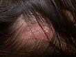 Recurring Scab On Scalp In The Same Spot: How to Treat