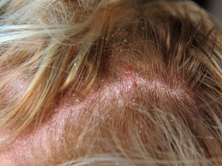 Yeast Infection On Scalp Expert Review Of Causes Symptoms And Treatment