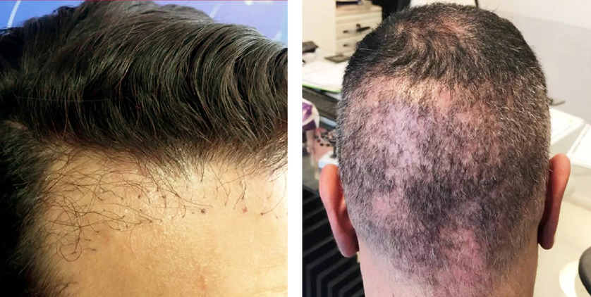 16 Turkish Hair Transplant Clinic Red Flags - Wimpole Clinic