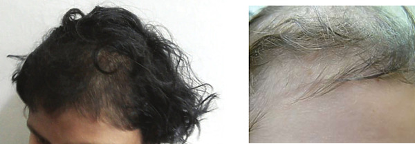 Trichotillomania Hair Regrowth Tips - Wimpole Clinic