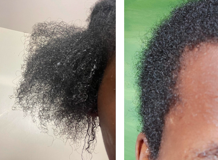 What To Do About Frizzy Broken Hair On Top Of Your Head